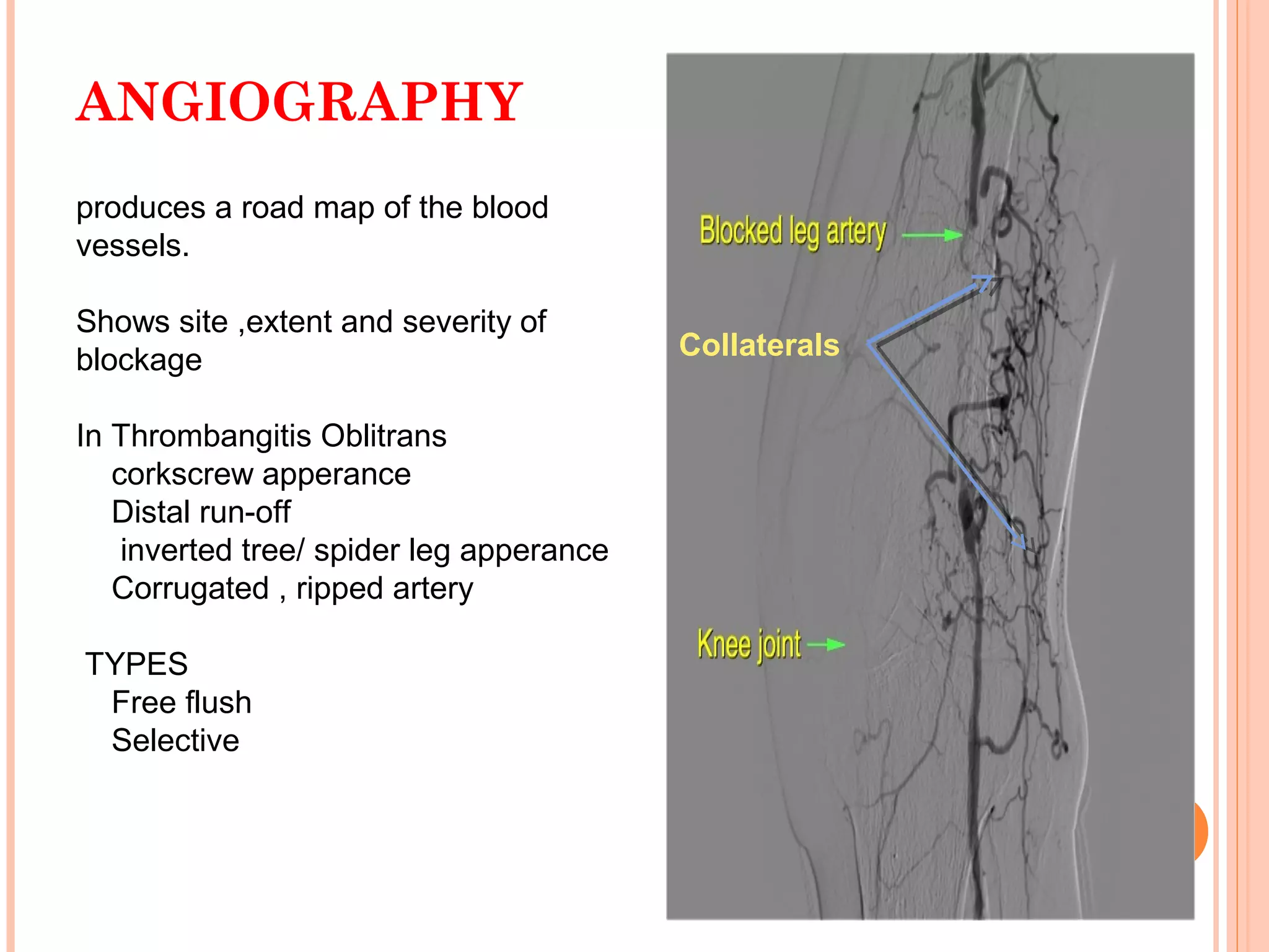 Chronic limb ischemia | PPT