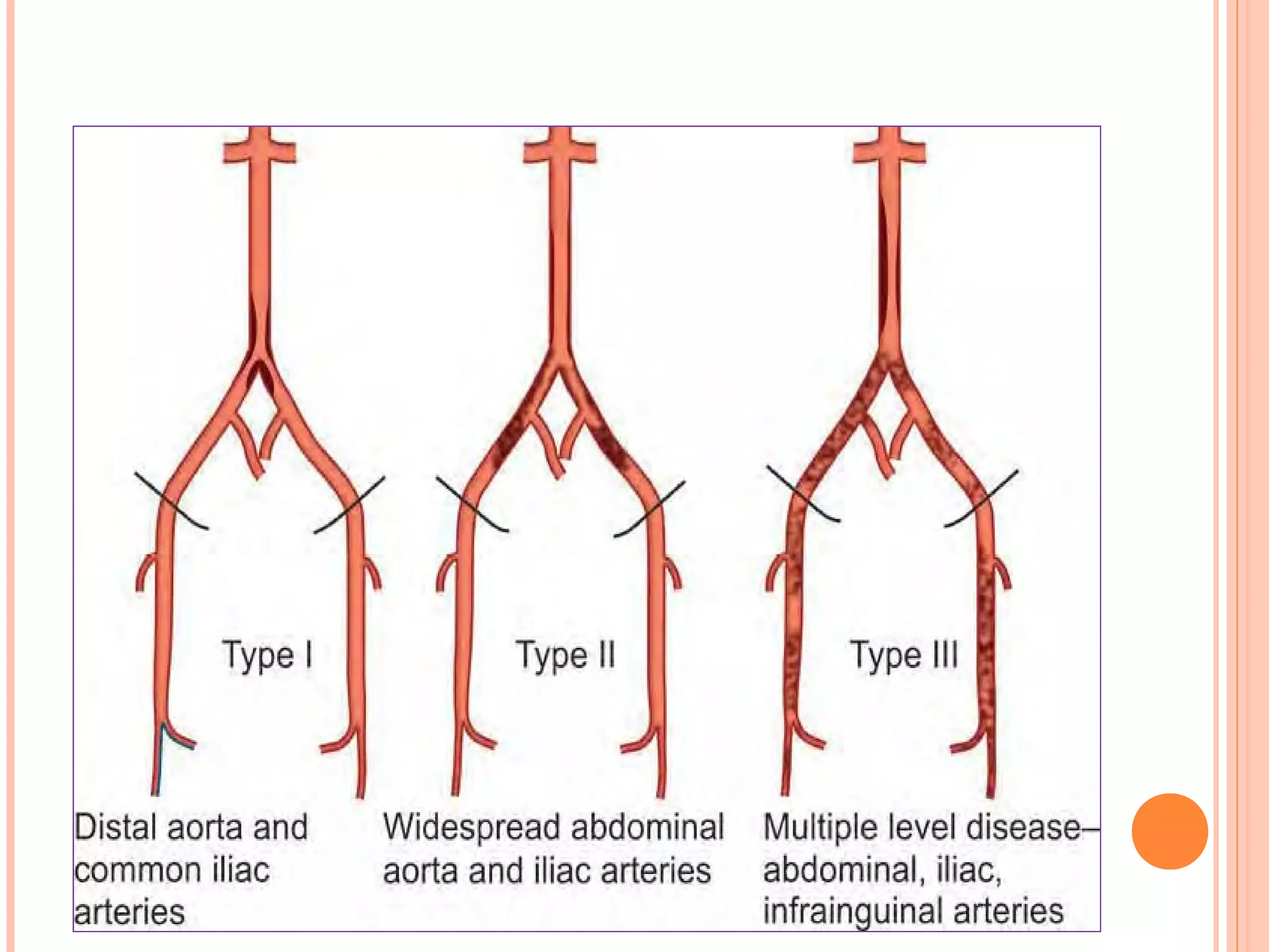 Chronic limb ischemia | PPT
