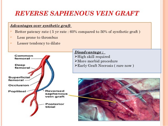 Chronic limb ischemia