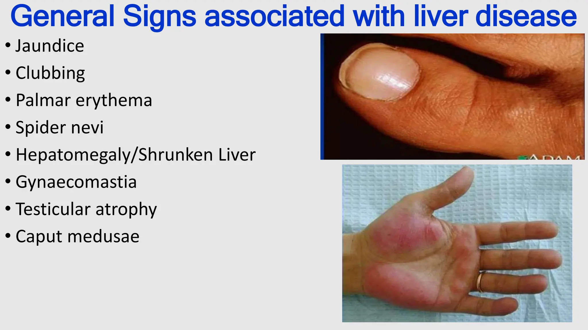 Chronic liver disease in the children .pptx