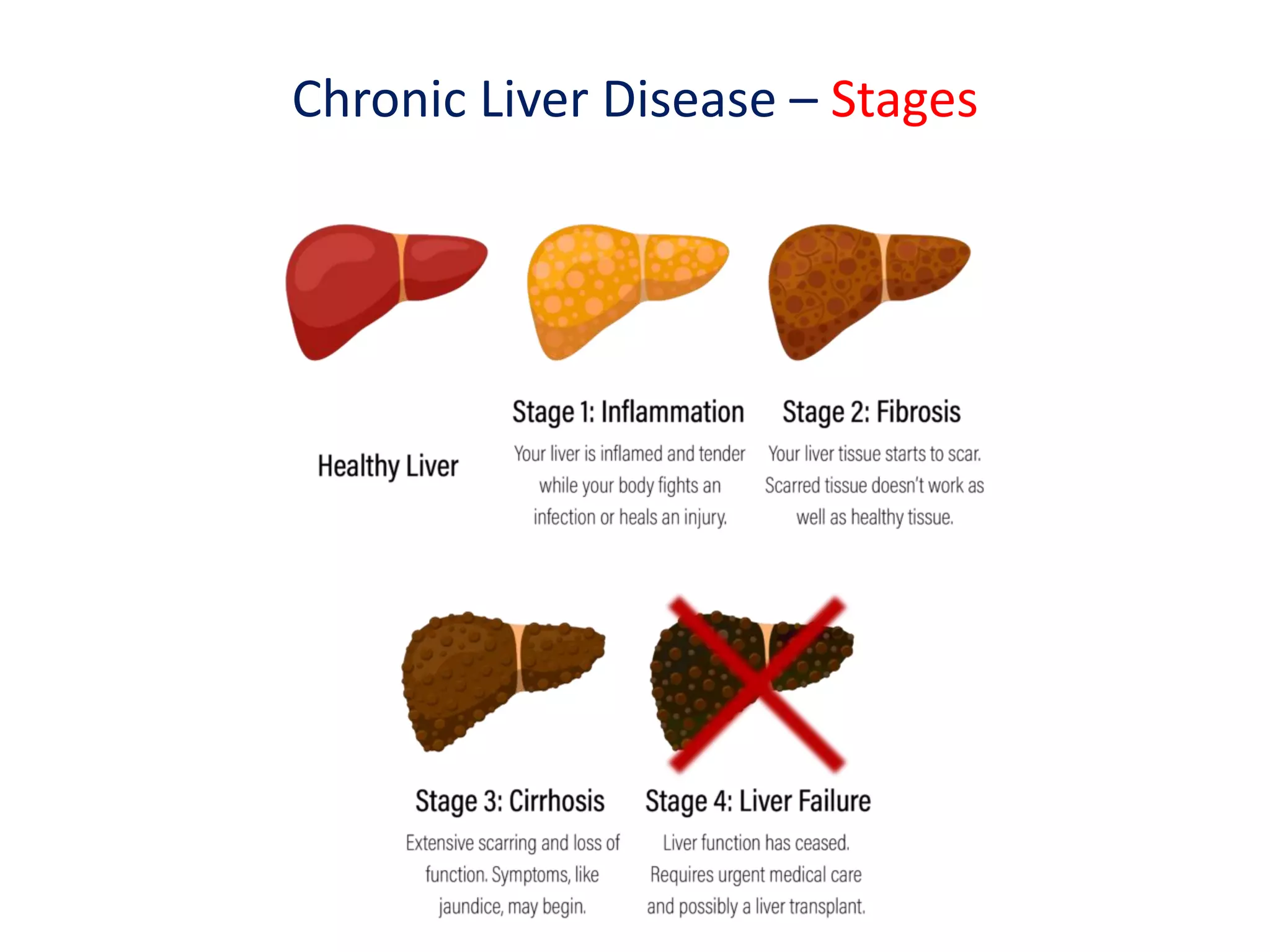 Chronic liver disease in children 2021 | PDF