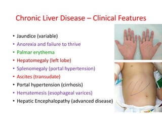 Chronic liver disease in children 2021 | PDF