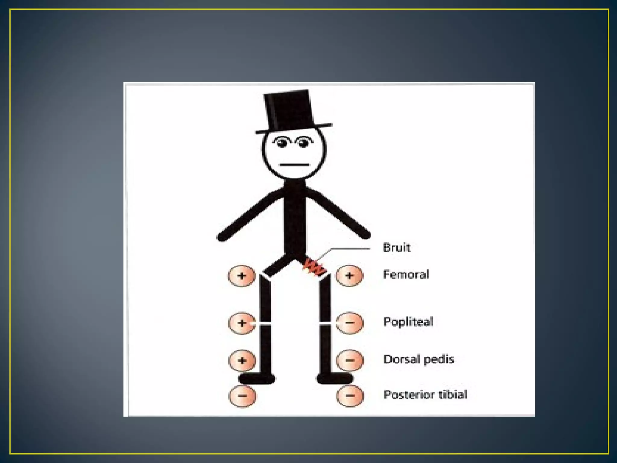 Chronic lower limb ischemia | PPT