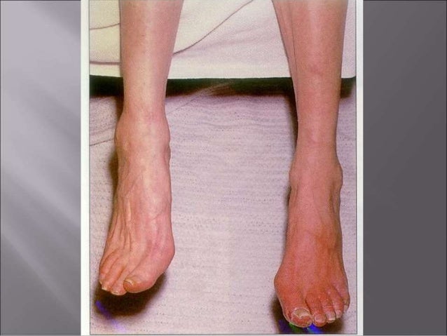 Chronic lower limb ischemia