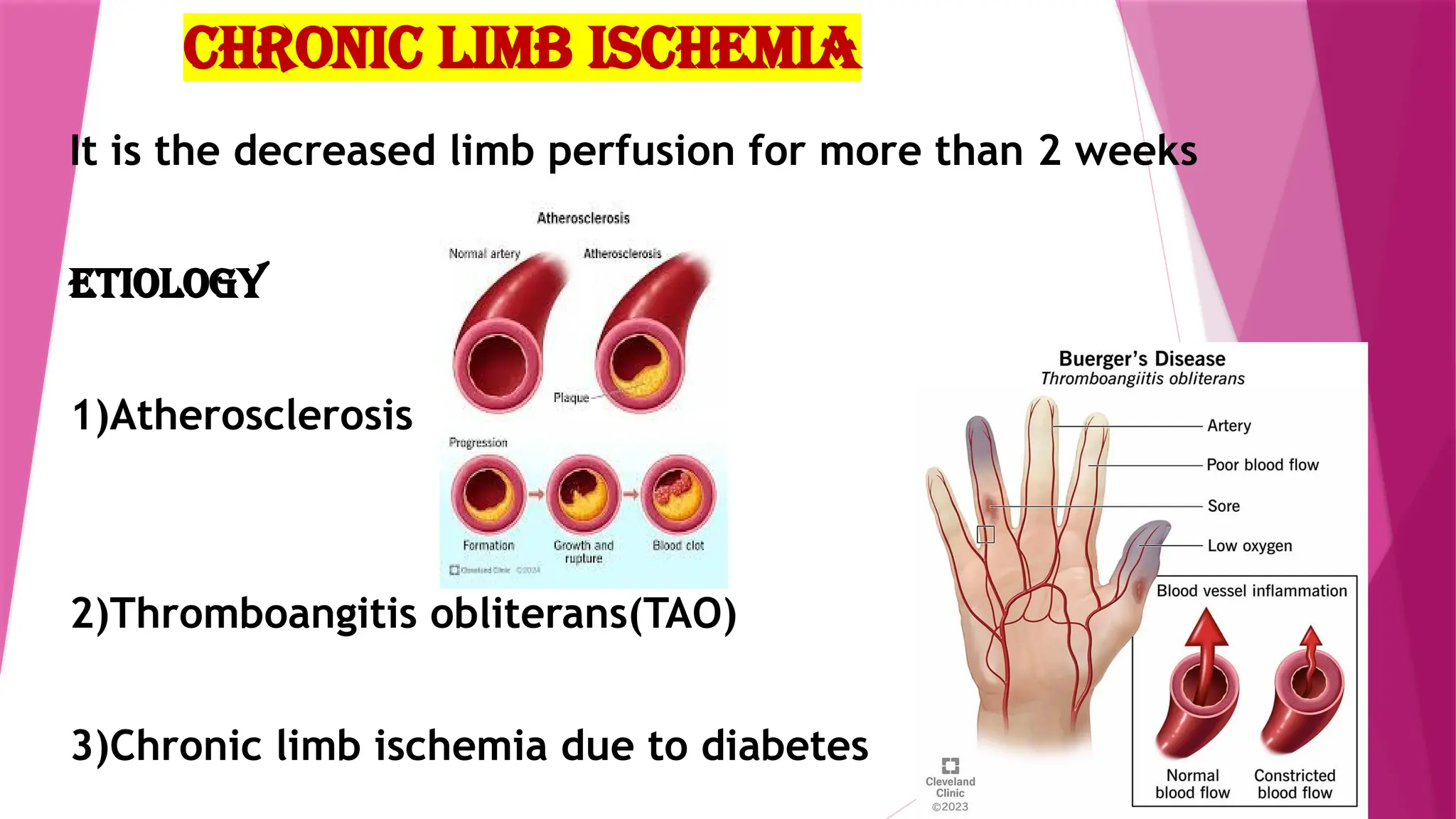 CHRONIC LOWER LIMB ISCHEMIA new.pptxTypes , clinical features | PPT