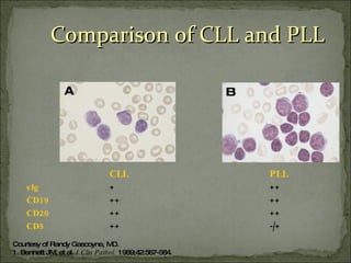 Chronic lymphocytic leukemia | PPT