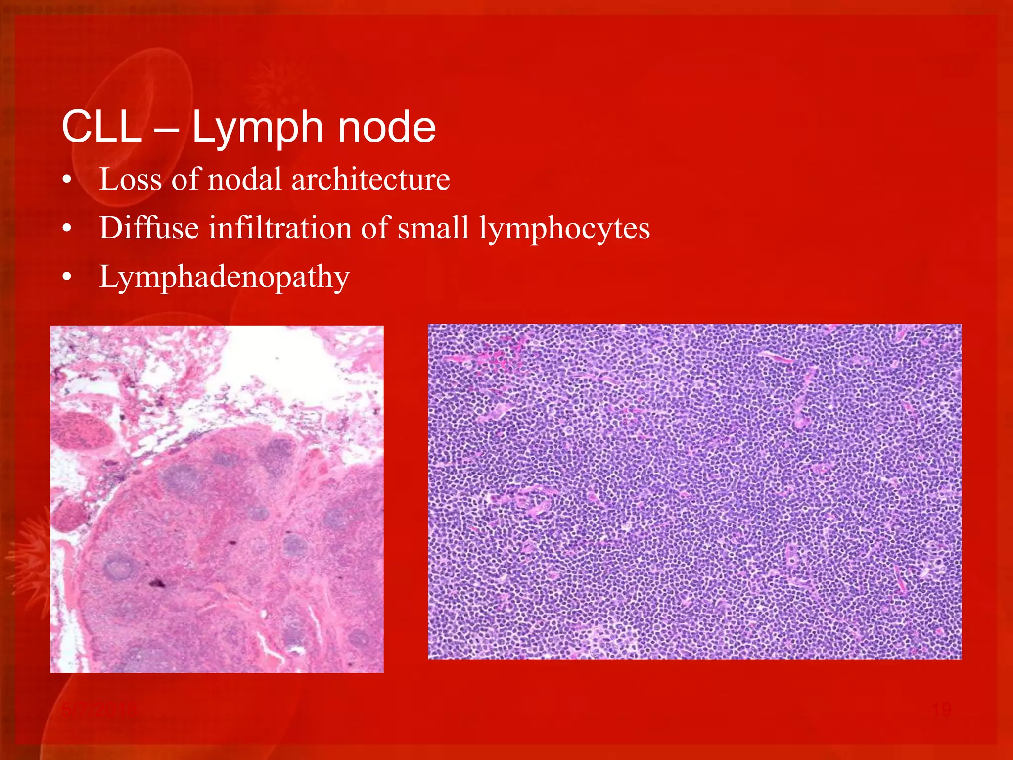 Chronic lymphocytic leukemia | PPTX