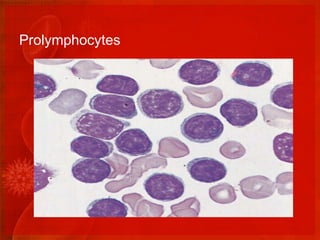 Chronic lymphocytic leukemia | PPTX