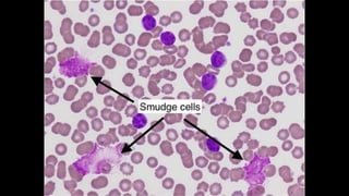 Chronic Lymphocytic Leukemia Smudge Cells