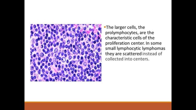 Chronic lymphocytic leukemia | PPT