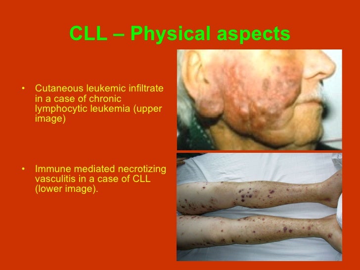 Chronic Lymphocytic Leukemia And Hairy Cell Leukemia
