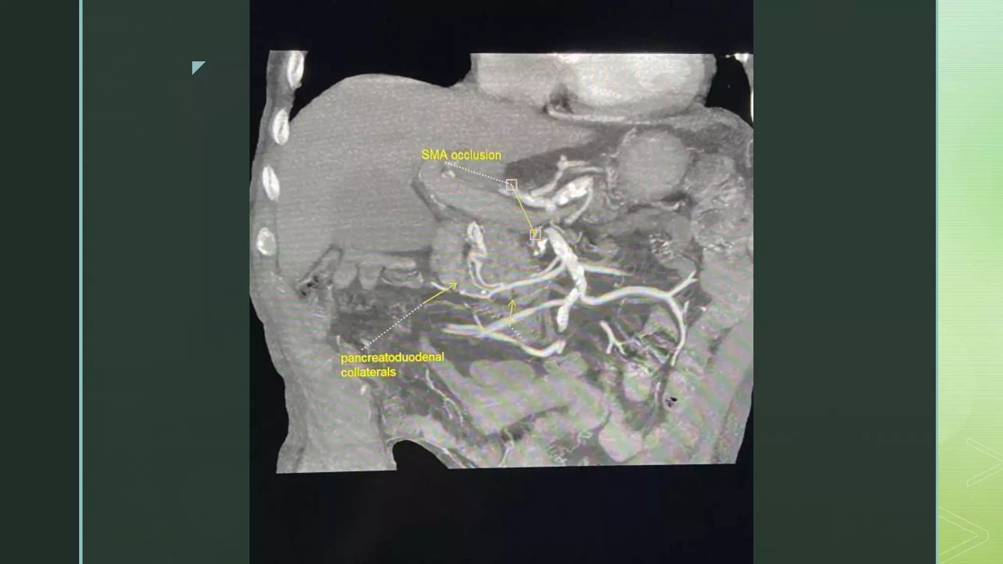 Chronic Mesenteric Ischemia | PPTX
