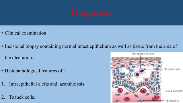 Chronic multiple Oral ulcers | PPTX | Skin and Dermatology | Diseases ...