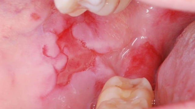 Chronic multiple Oral ulcers | PPTX | Skin and Dermatology | Diseases ...