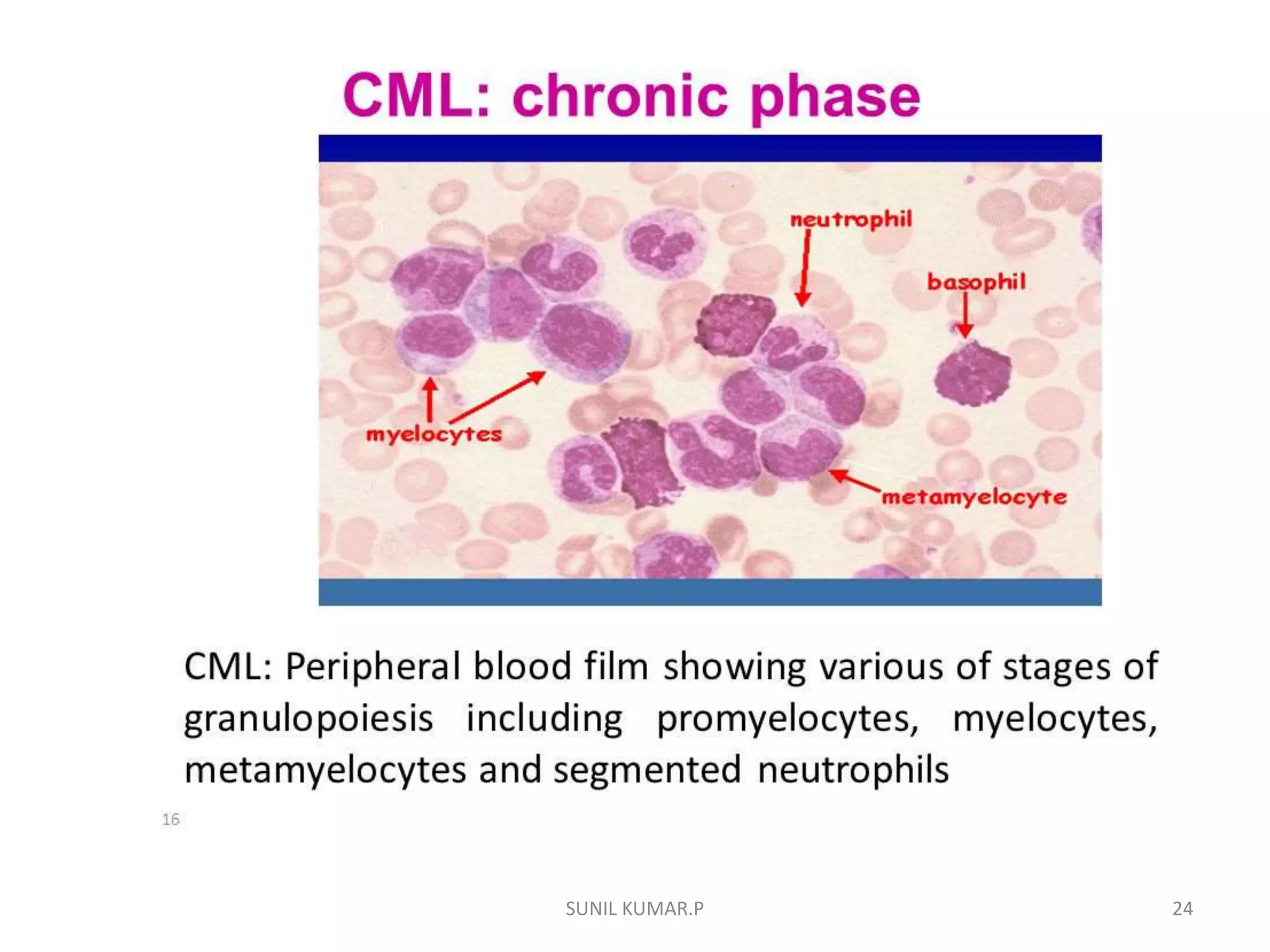 Chronic myelogenous leukemia | PPTX