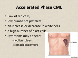 Chronic myeloid leukemia | PPTX