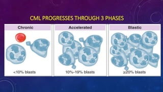 Chronic Myeloid Leukemia by Dr. Sookun Rajeev Kumar | PPT