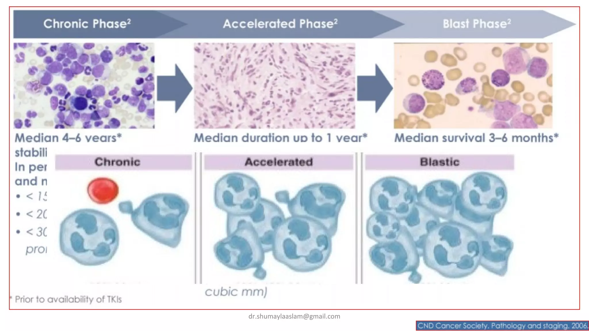 Chronic myeloid leukemia (CML) | PPT