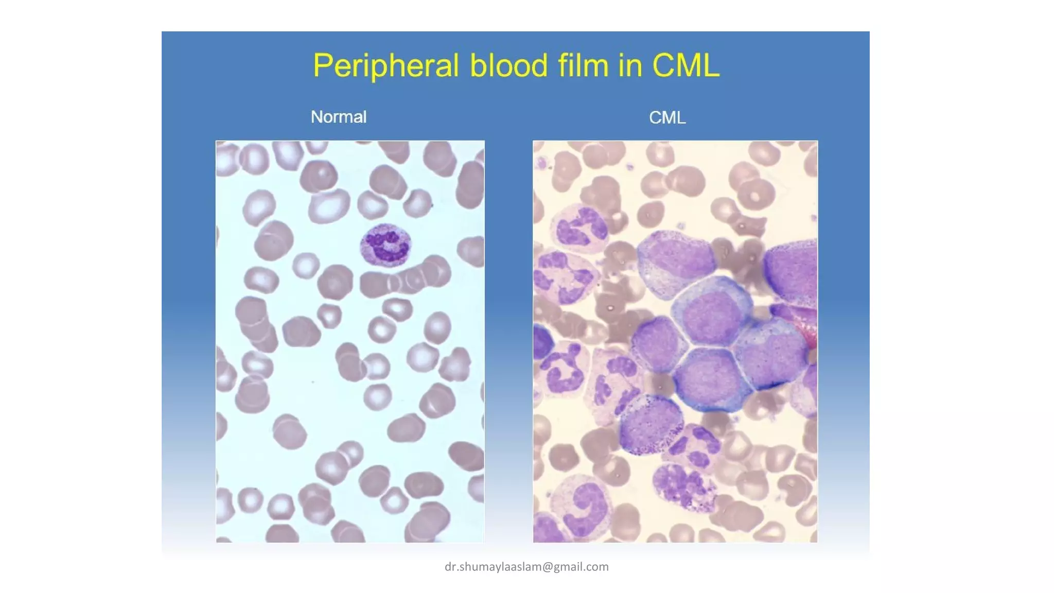 Chronic myeloid leukemia (CML) | PPT