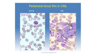 Chronic myeloid leukemia (CML) | PPT