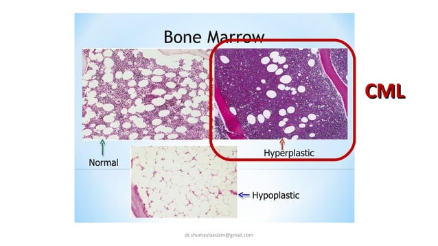 Chronic myeloid leukemia (CML) | PPT