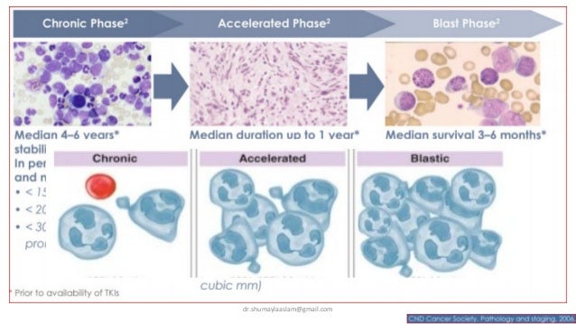 Chronic myeloid leukemia (CML)
