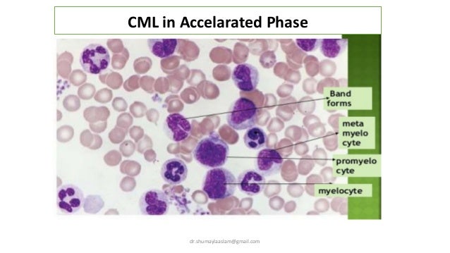 Chronic myeloid leukemia (CML)