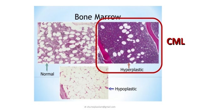 Chronic myeloid leukemia (CML)