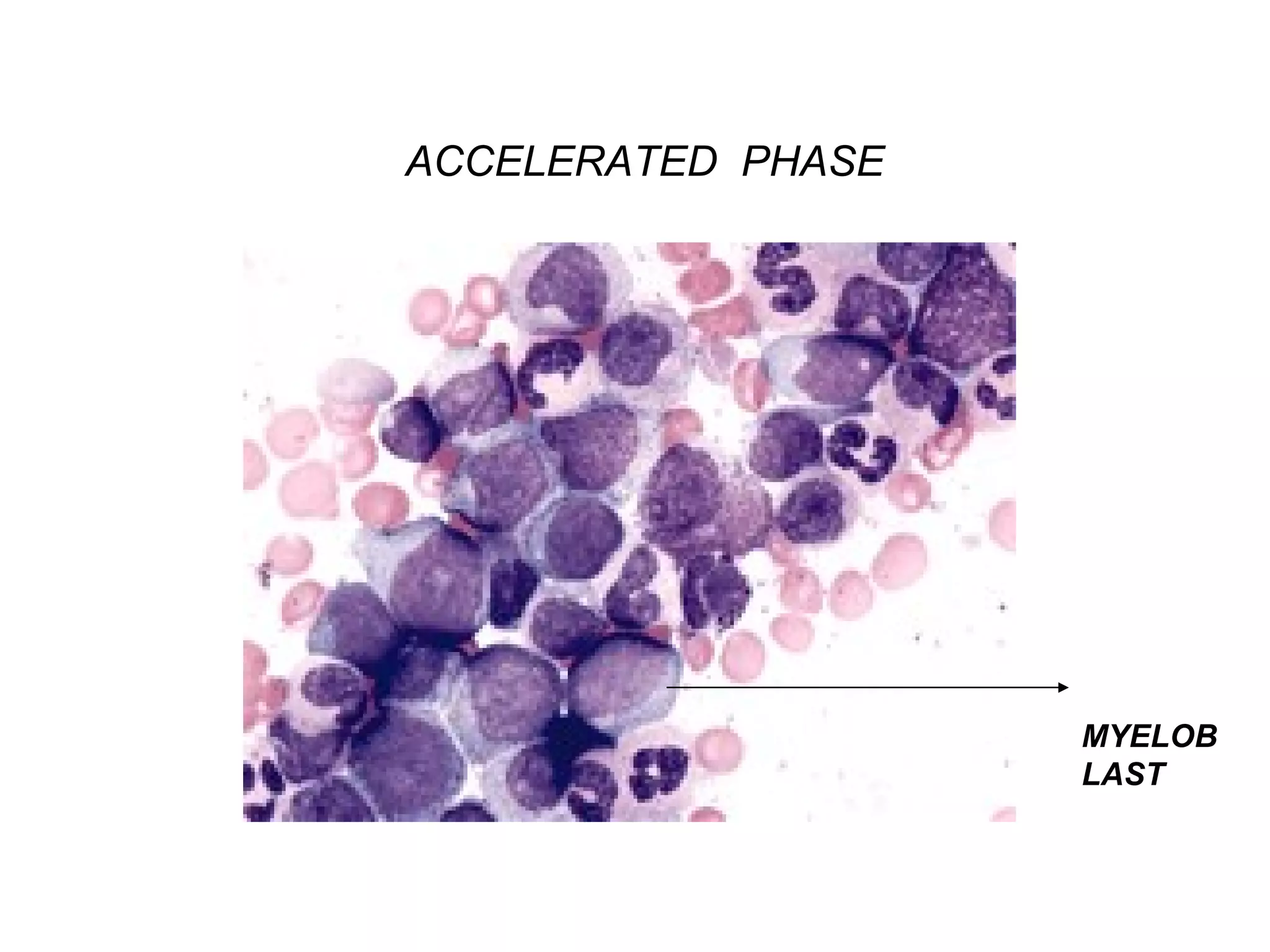 Chronic Myeloid Leukaemia | PPT