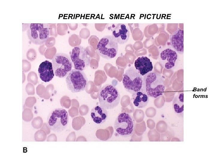 Chronic Myeloid Leukaemia