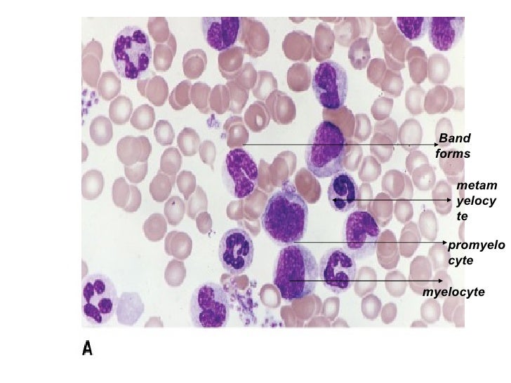 Chronic Myeloid Leukaemia