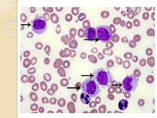 Chronic myelomonocytic leukemia (cmml) | PPT