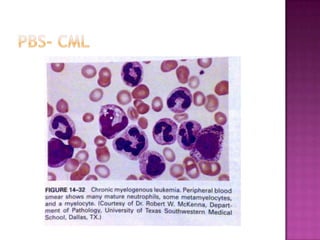 Chronic Myeloproliferative Disorder | PPTX