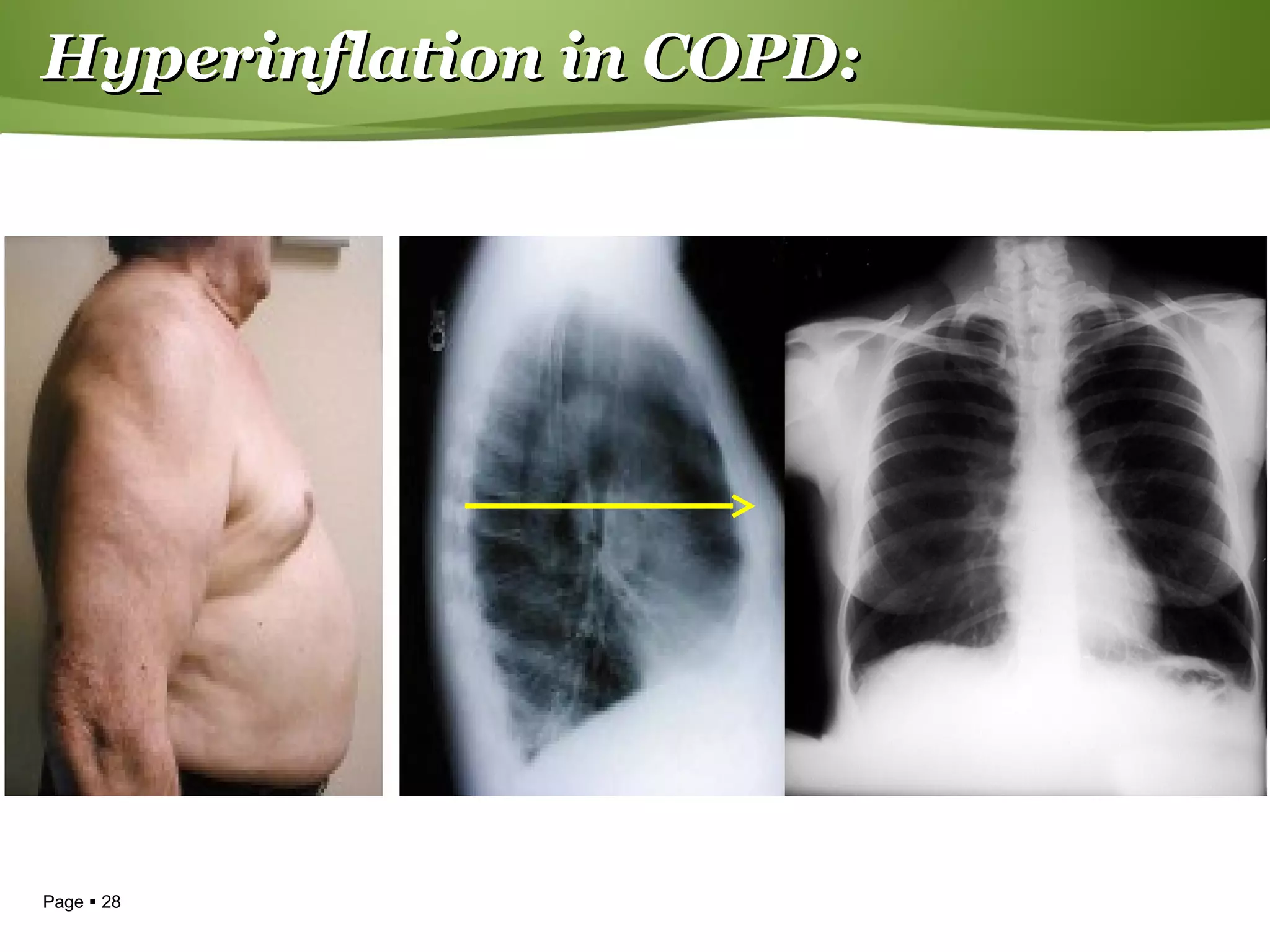 Chronic obstructive pulmonary disease | PPT