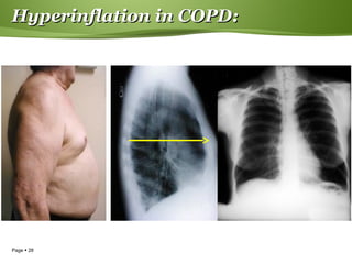 Chronic obstructive pulmonary disease | PPT