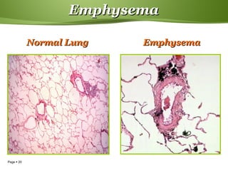 Emphysema Lung Slide