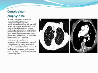 Chronic obstructive pulmonary disease | PPTX