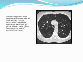 Chronic obstructive pulmonary disease | PPTX