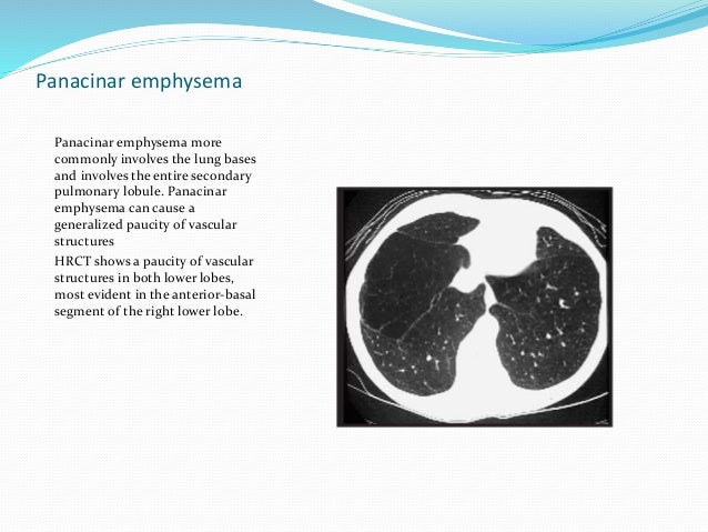 Chronic obstructive pulmonary disease