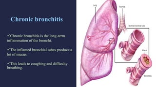 Chronic obstructive pulmonary disease | PPT