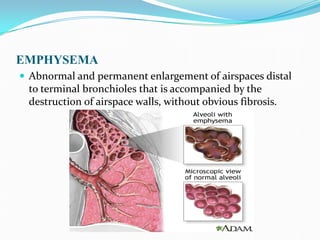 Chronic obstructive pulmonary disorder | PDF