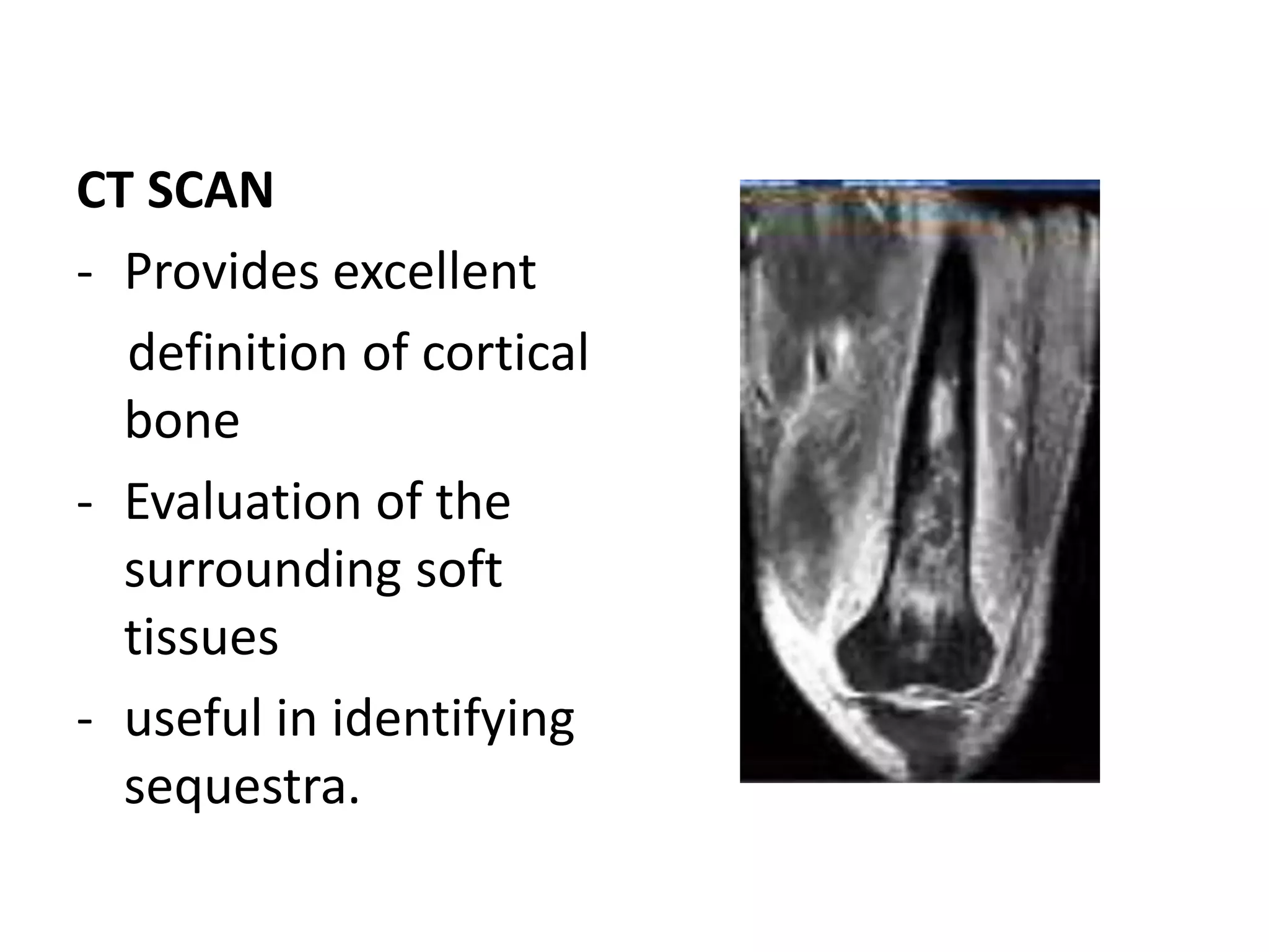 CHRONIC OSTEOMYELITIS | PPTX