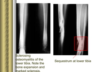Chronic osteomyelitis | PPT
