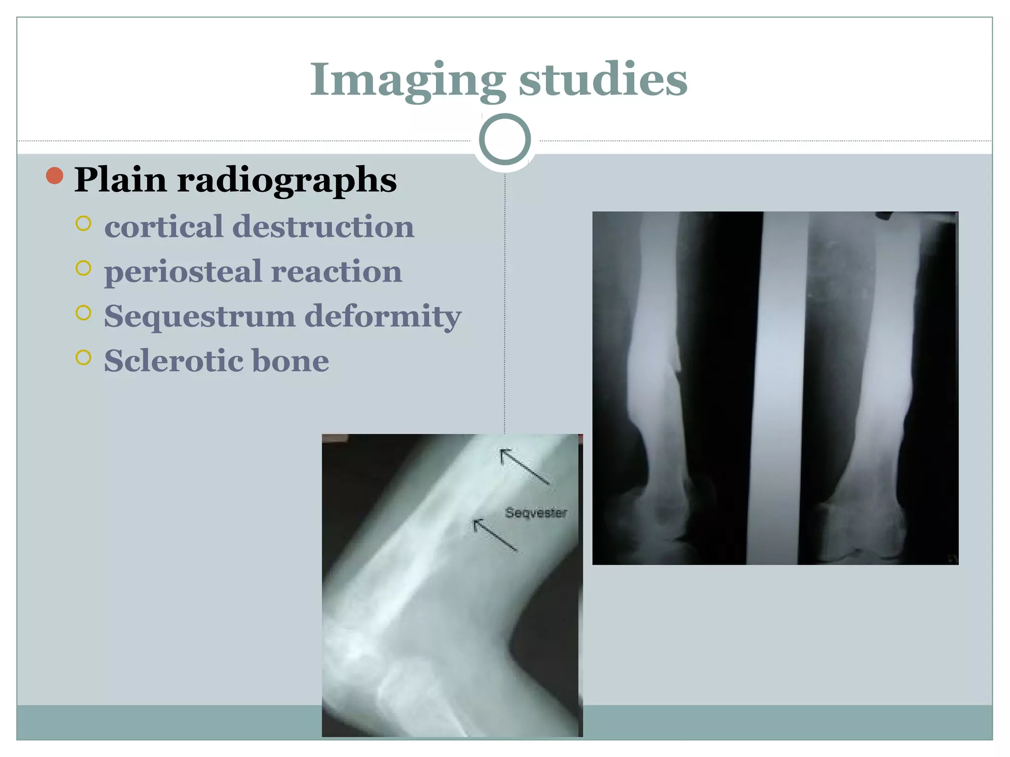 Chronic osteomyelitis | PPT