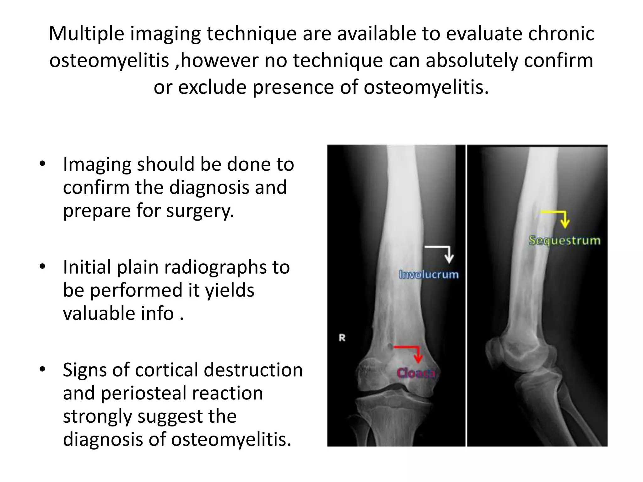 Chronic osteomyelitis | PPTX