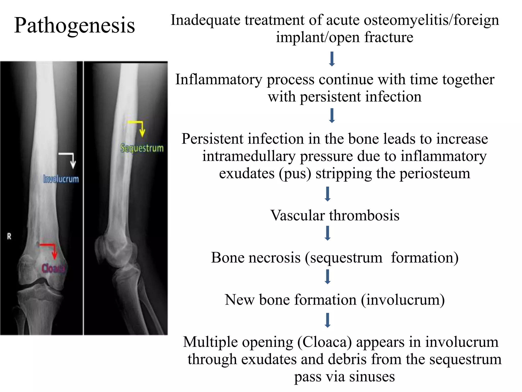 Chronic osteomyelitis | PPTX