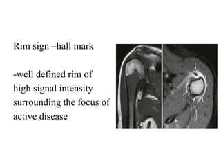 Chronic osteomyelitis | PPTX