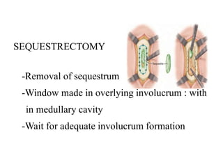 Chronic osteomyelitis | PPT