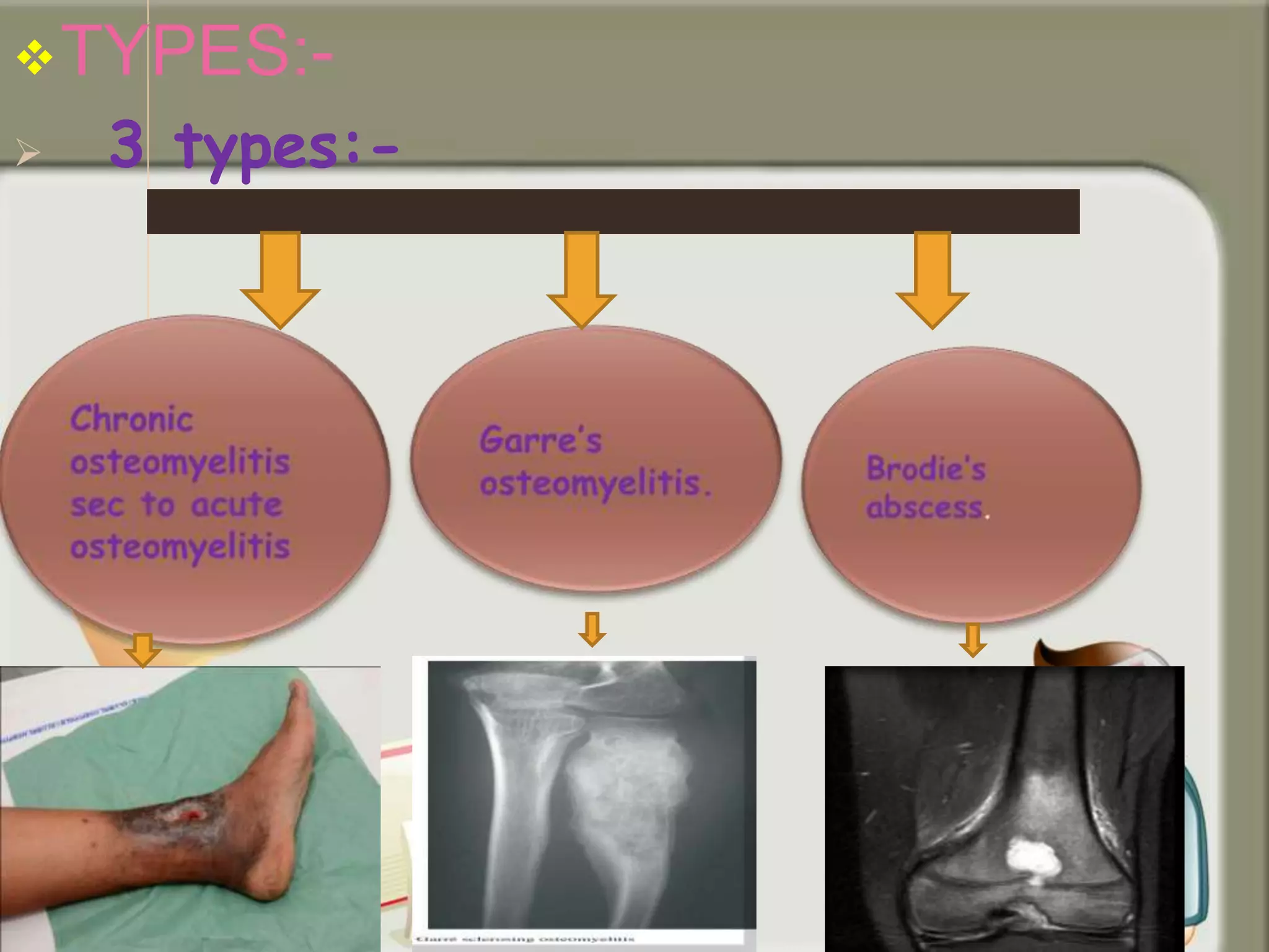 Chronic osteomyelitis | PPT