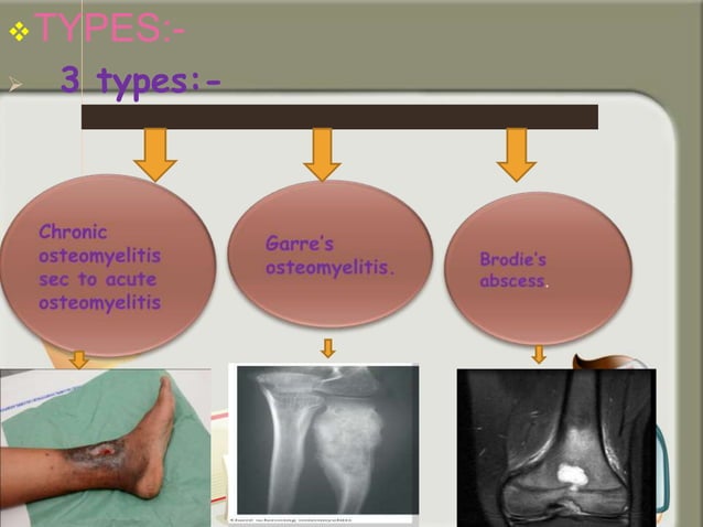 Chronic osteomyelitis | PPT